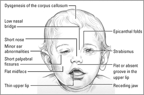 Fetal Alcohol Syndrome Nurse Key