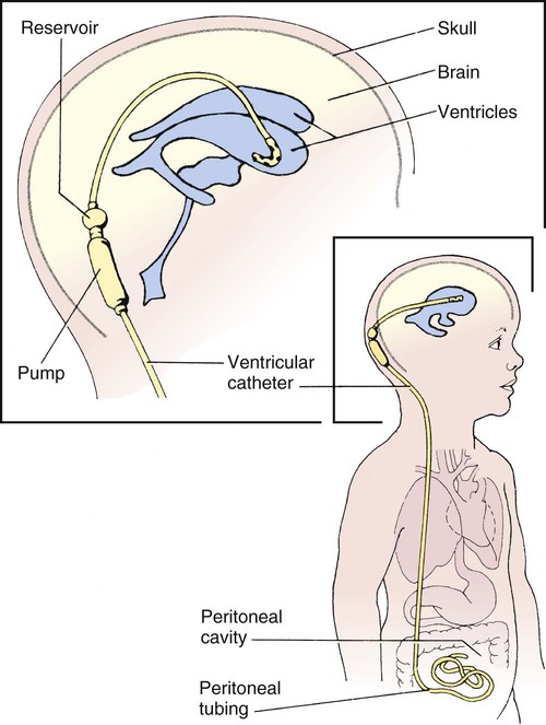 Neurologic And Sensory Disorders Nurse Key