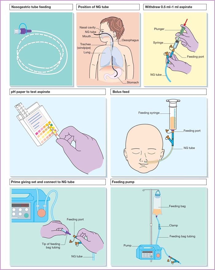 What Is A Nasogastric Tube And Why Was It Used